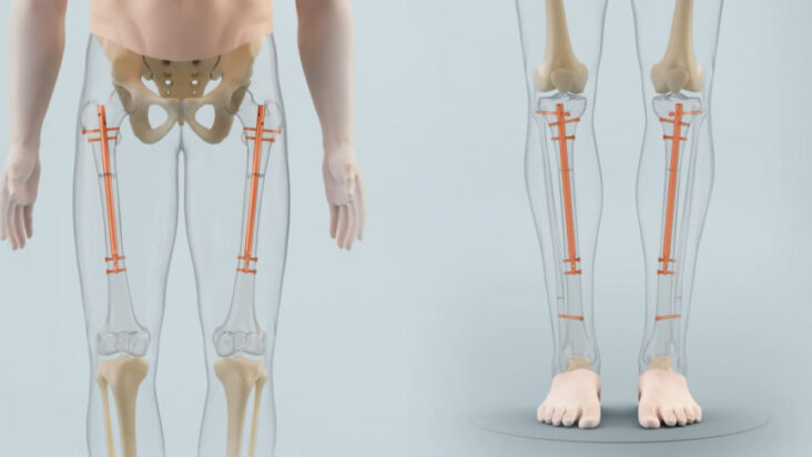 What Is Limb Lengthening Surgery And Why Are Young Men Getting It ...