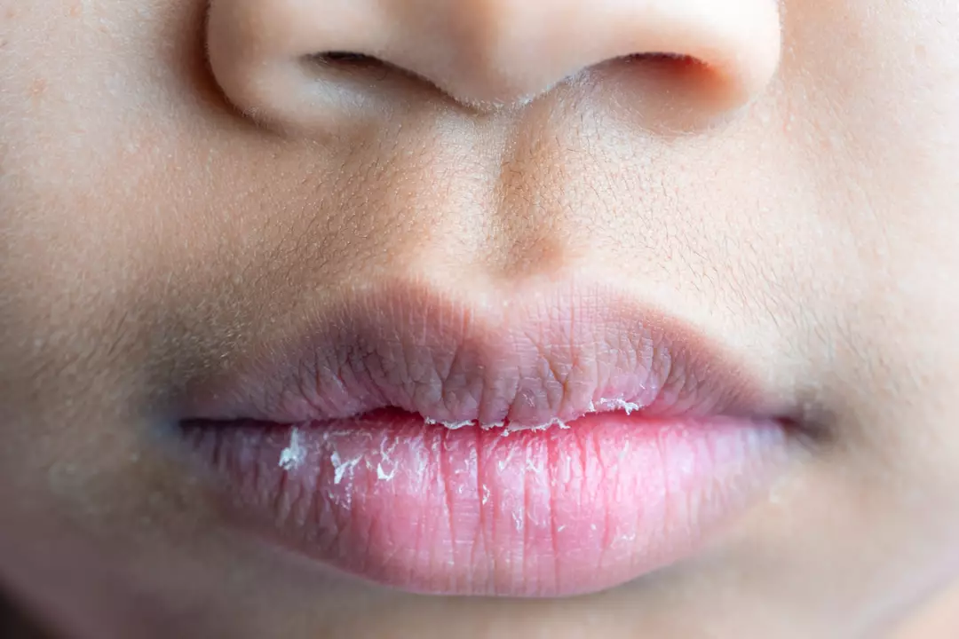 Expert Unveils Possible Causes of Persistent Cracked Lips That May ...