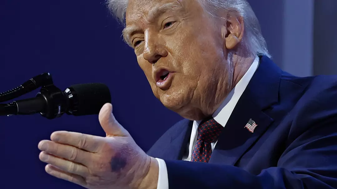 Trump clarifies cause of hand bruise after recent photos raise alarm ...